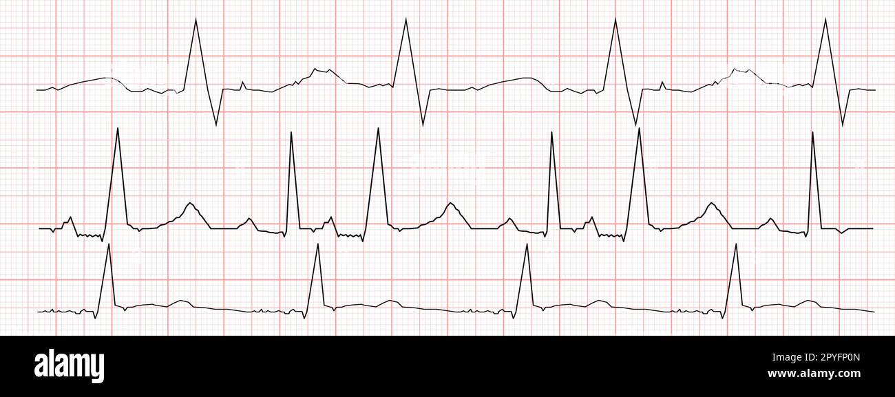 Set of black heartbeat diagrams on red graph paper. ECG ...