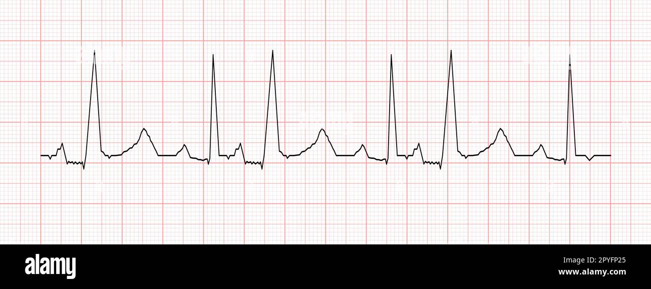 Black heart beat diagram on red graph paper. ECG chart. Pulse rhythm ...