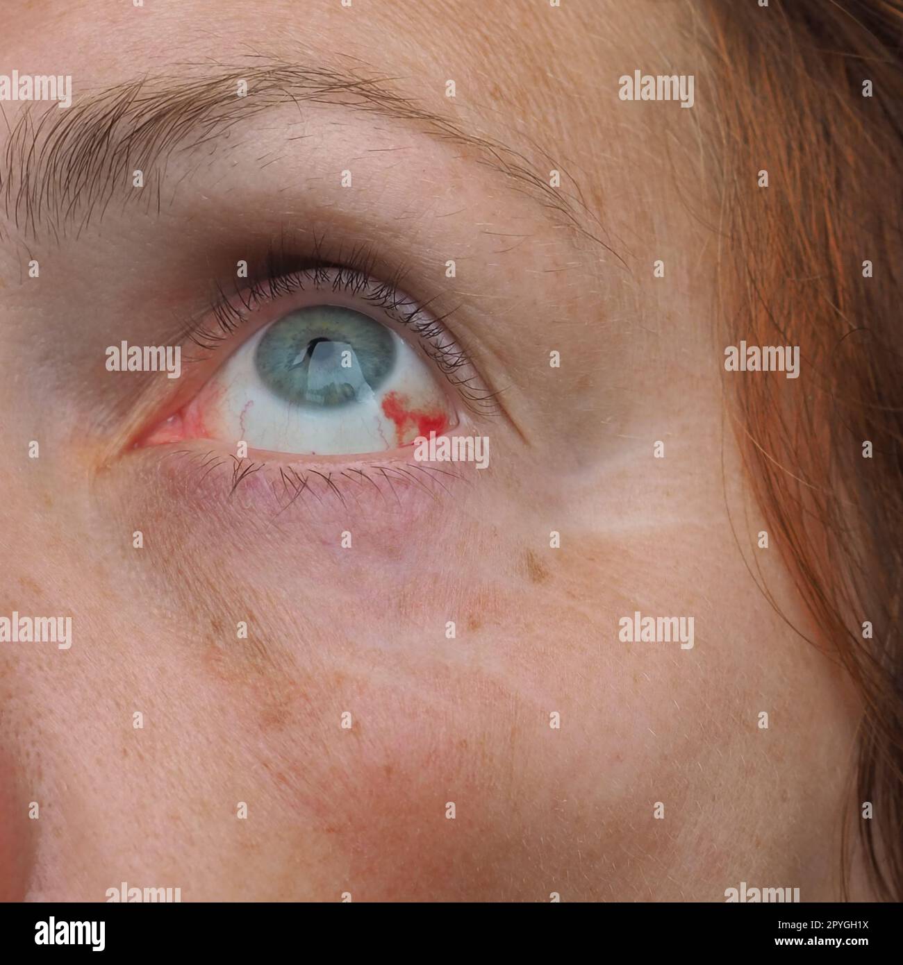 Inflamed conjunctiva hi-res stock photography and images - Alamy
