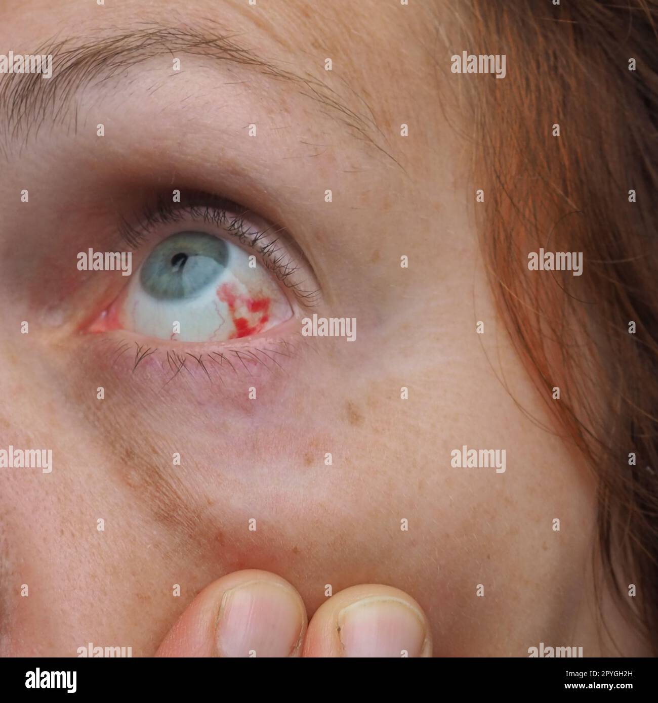 Subconjunctival hemorrhage or subconjunctival bleeding, hyposhagmus ...