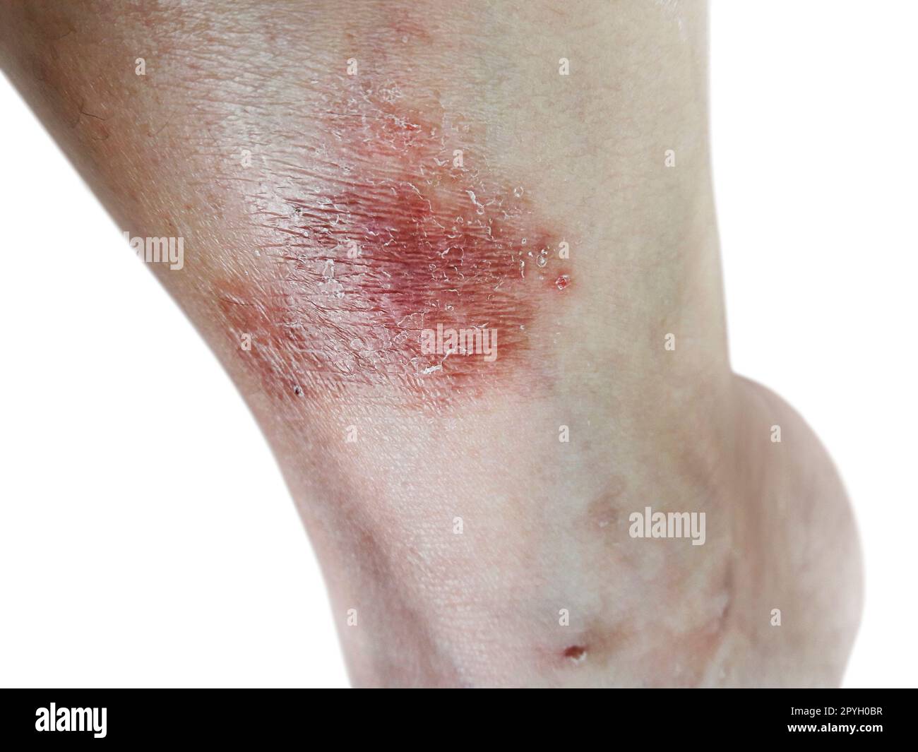 Close Up Dermatitis On Skin Ill Allergic Rash Dermatitis Eczema Skin