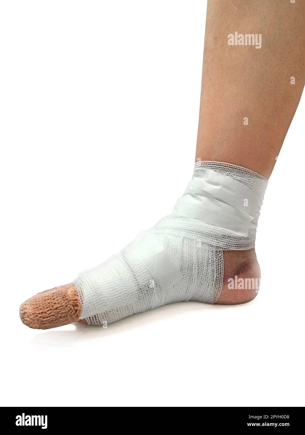close up a recently operated toe woman with bandages Stock Photo - Alamy