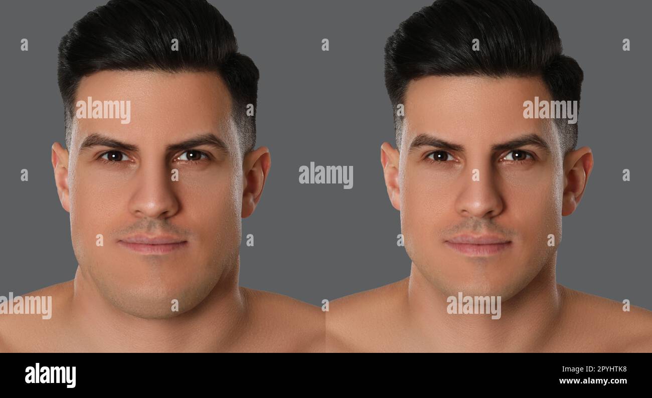 Double chin problem. Collage with photos of man before and after ...