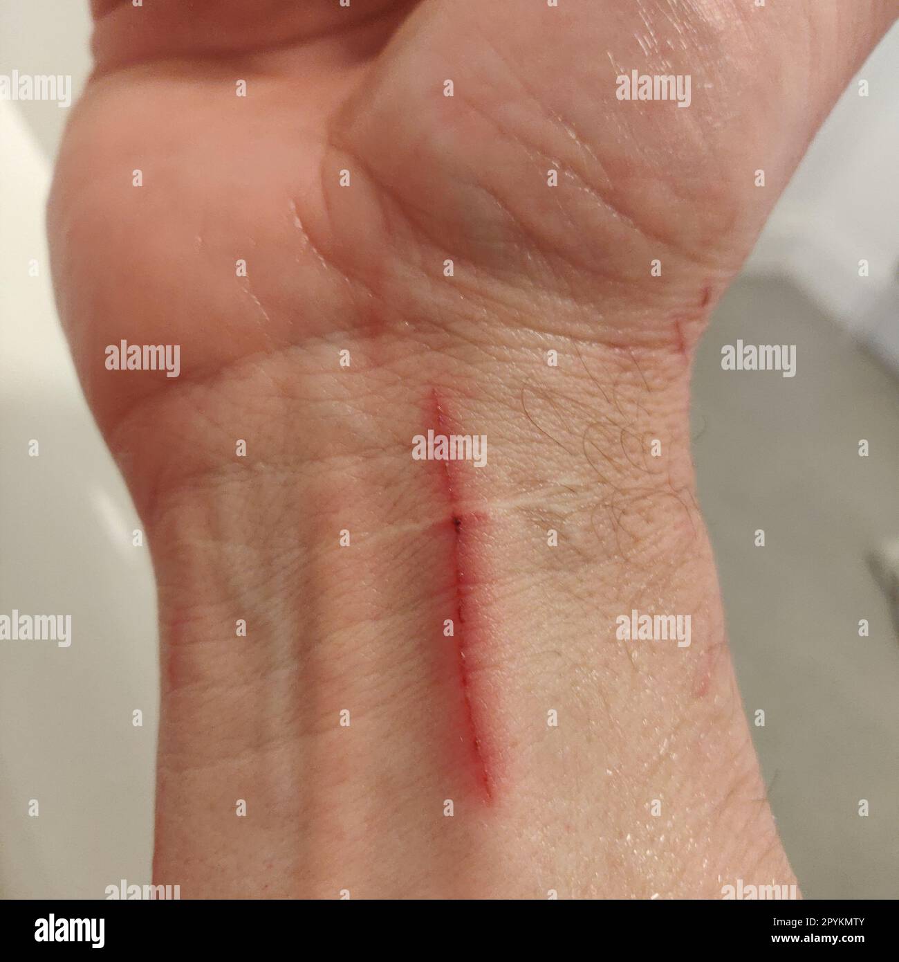 Wrist scar hi-res stock photography and images - Alamy