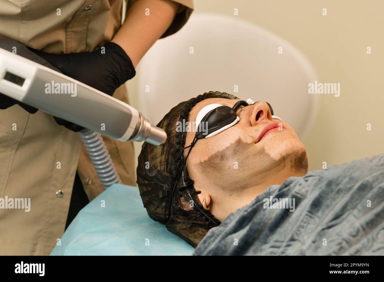 Carbon face peeling procedure in beauty salon. Laser pulses clean skin ...