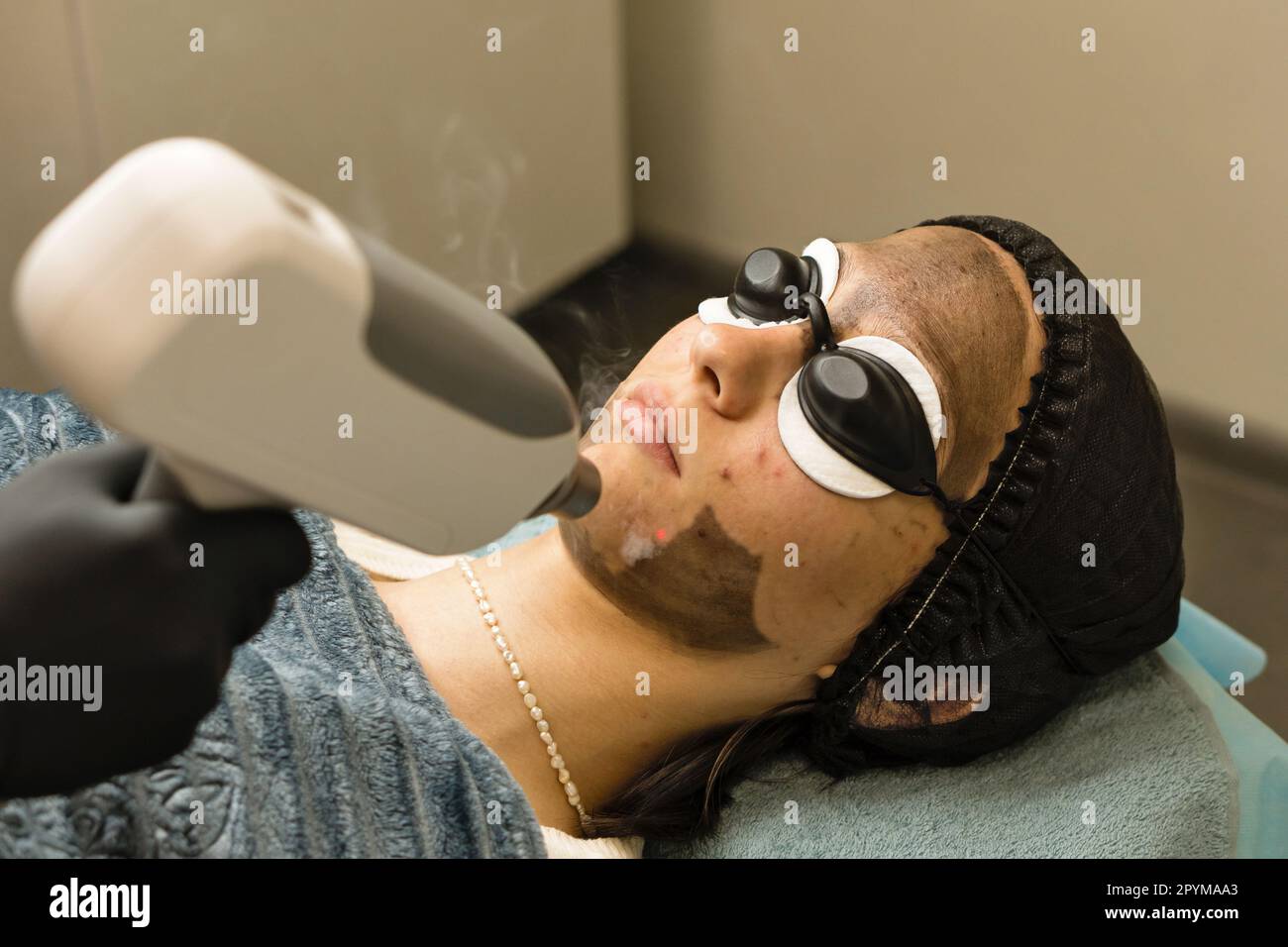 Carbon face peeling procedure in beauty salon. Laser pulses clean skin ...