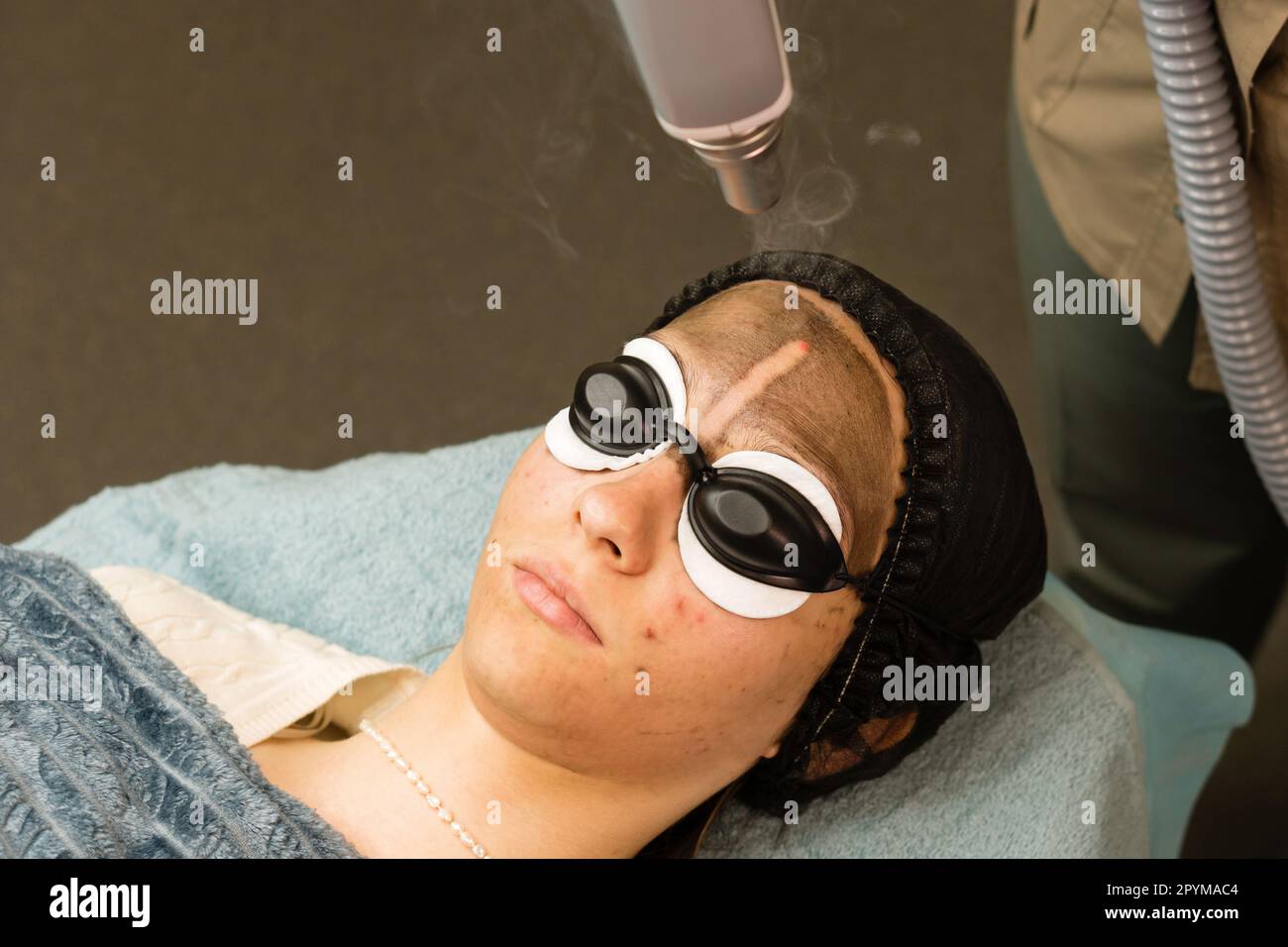 Carbon face peeling procedure in beauty salon. Laser pulses clean skin ...