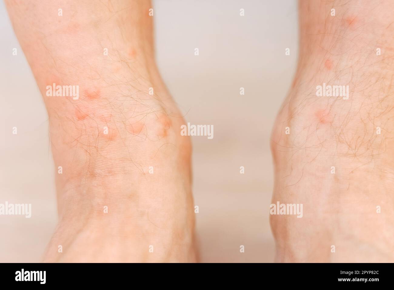 Close Up Allergic Rash Dermatitis Eczema On Man Foot Leg With Red Rash Caused By Insect Bites