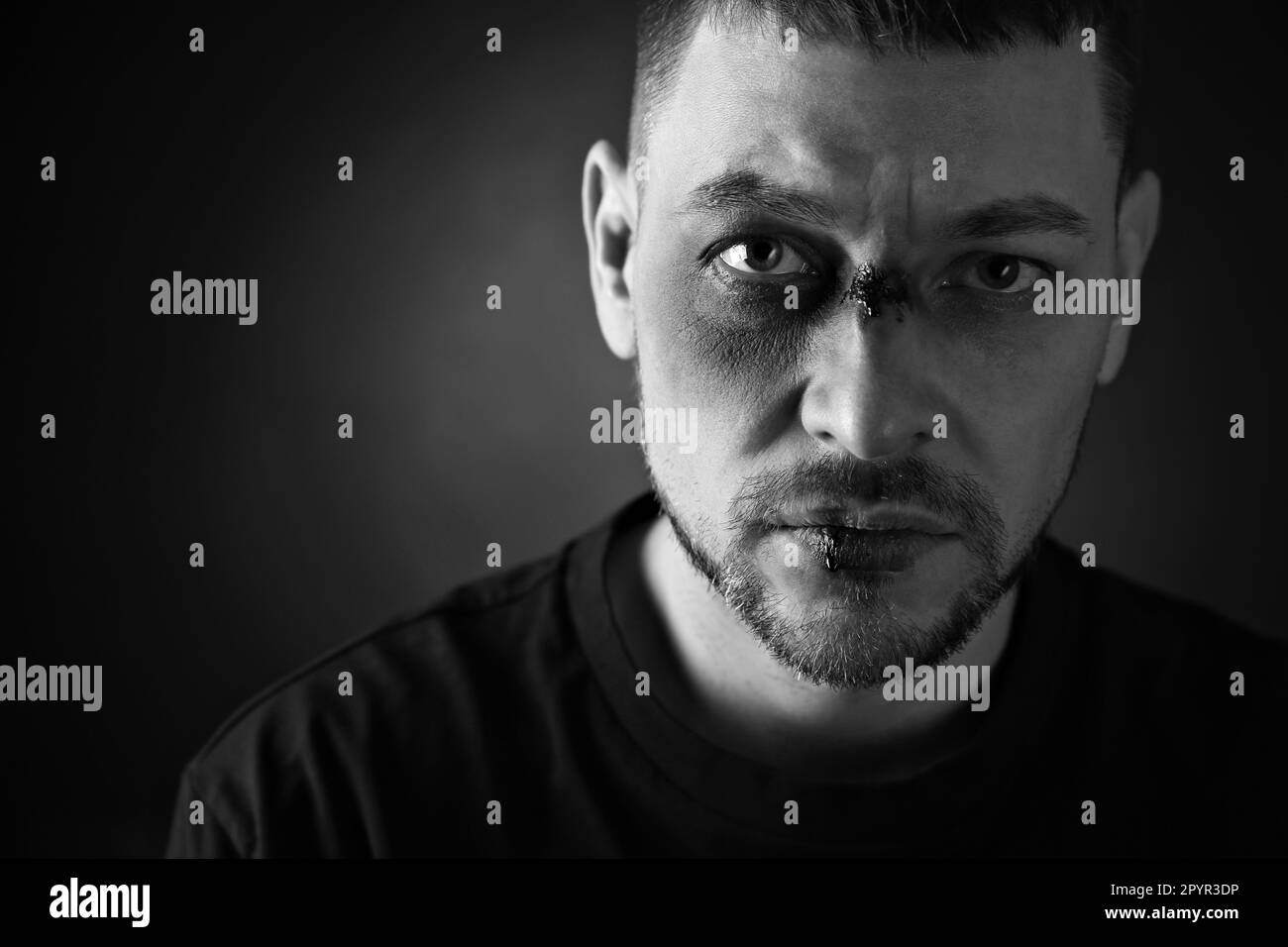 Traumatic injuries Black and White Stock Photos & Images - Alamy