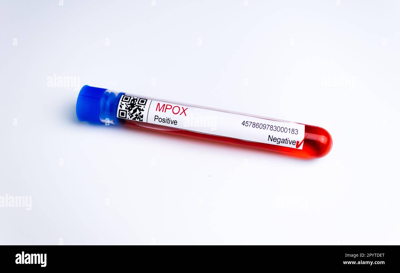 Close up of laboratory flask containing blood sample for testing of ...