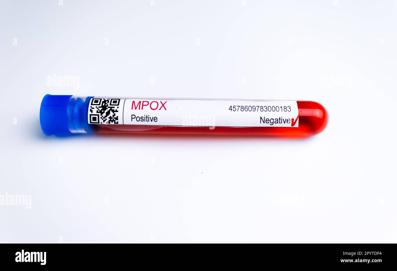 Close up of laboratory flask containing blood sample for testing of ...