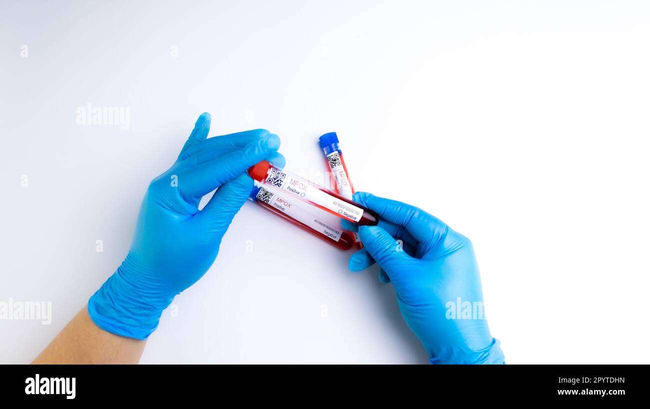 Gloved hands holding a laboratory flask containing a blood sample for a ...