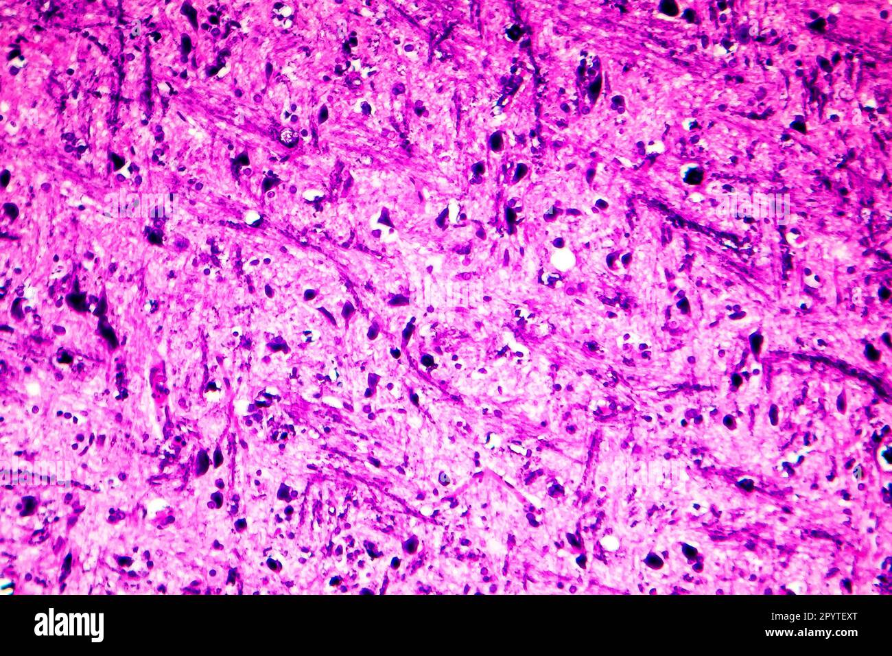 Human medulla oblongata, or myelencephalon, light micrograph Stock ...