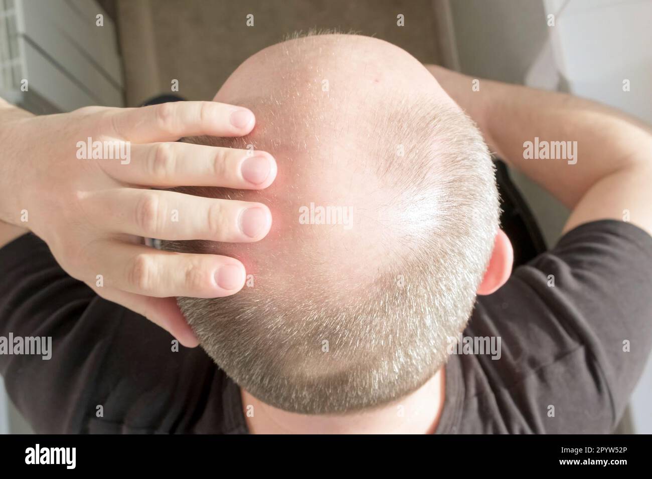 Baldness, man concerned about hair loss. Male head with bald. Fighting ...