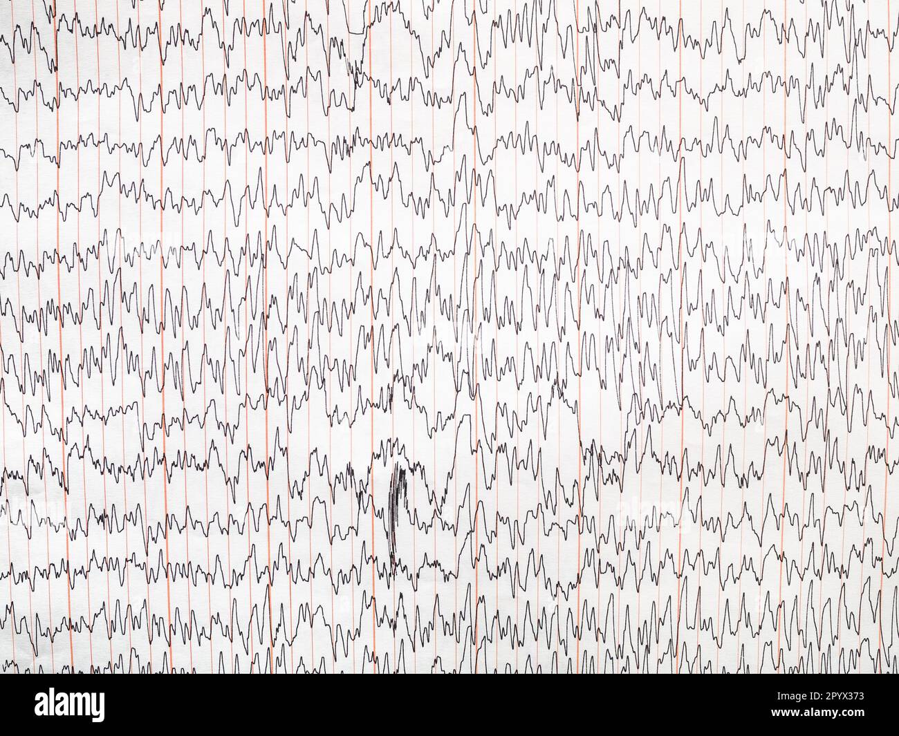 encephalogram on paper - graph of electrical activity of brain Stock ...