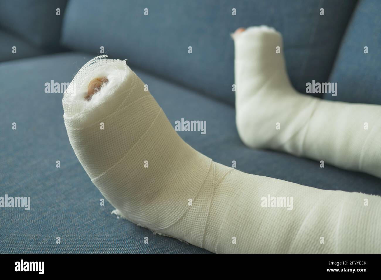 little child with plaster bandage on leg Stock Photo - Alamy