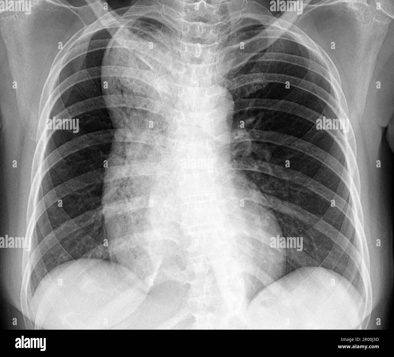 Achalasia of the oesophagus, X-ray Stock Photo - Alamy