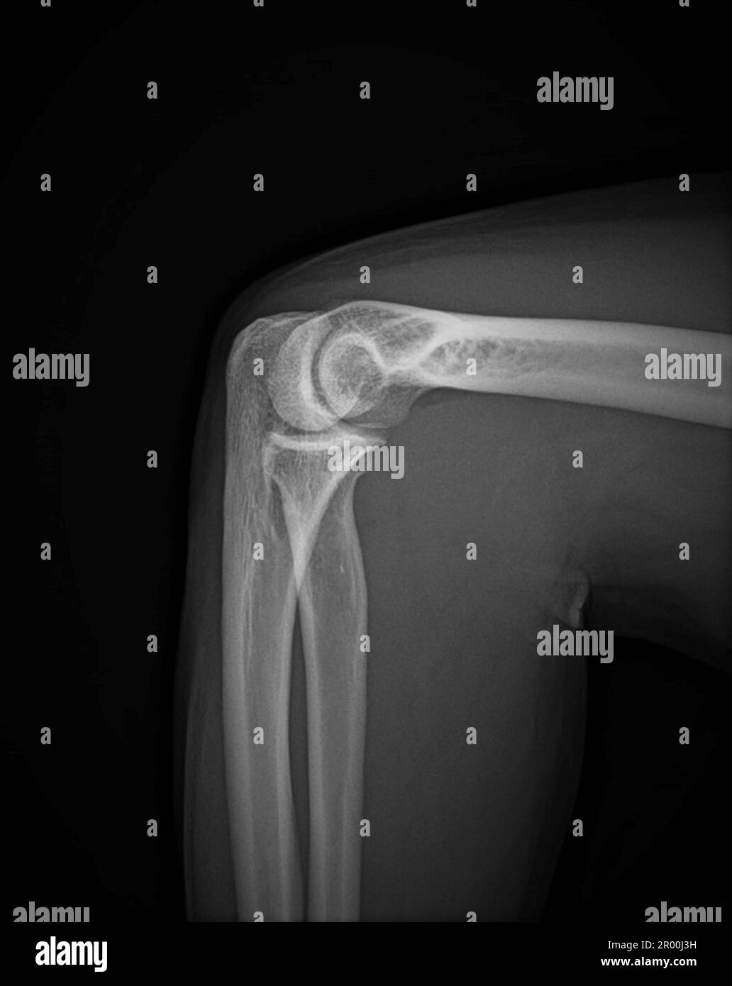 Healthy elbow joint, X-ray Stock Photo - Alamy