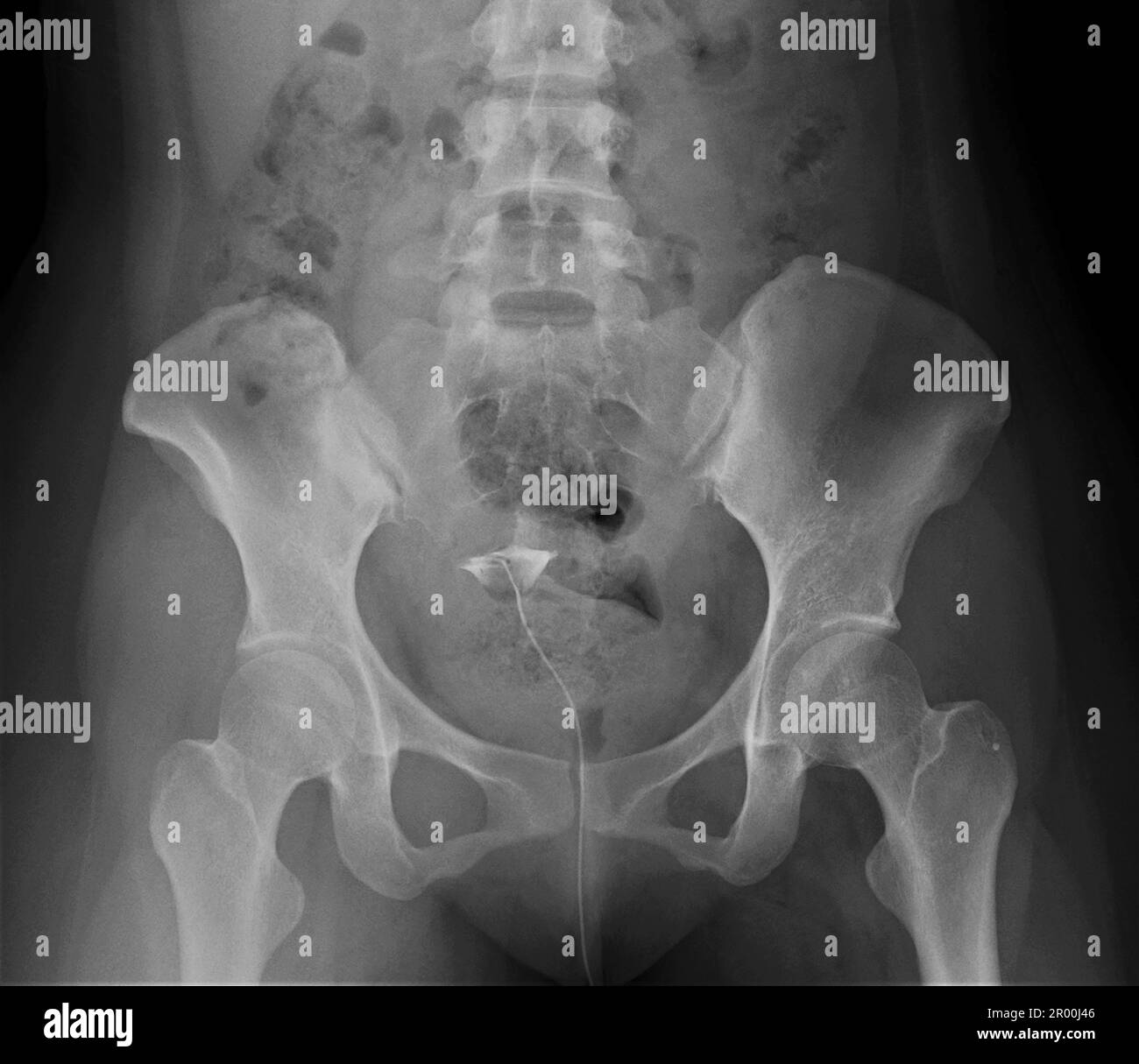 Obstructed fallopian tubes, X-ray Stock Photo - Alamy