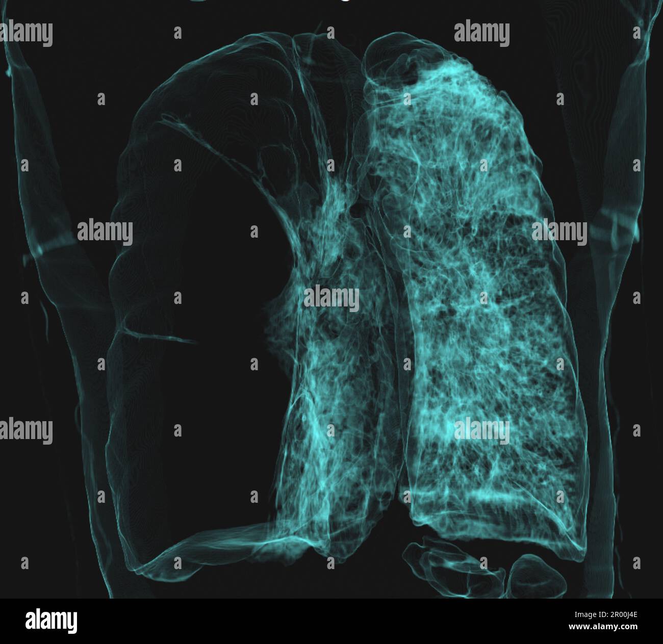 Pulmonary giant bulla, CT scan Stock Photo - Alamy