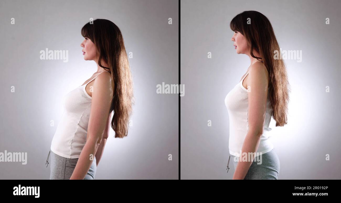 Woman With Lordosis And Normal Curvature Against Gray Background Stock ...