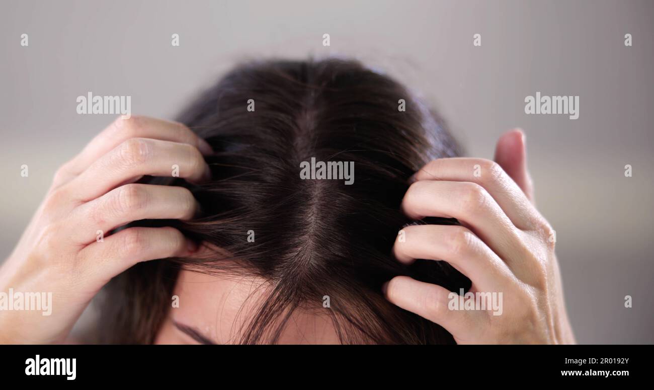 Hair Dandruff And Itchy Scalp Problem Treatment Stock Photo - Alamy