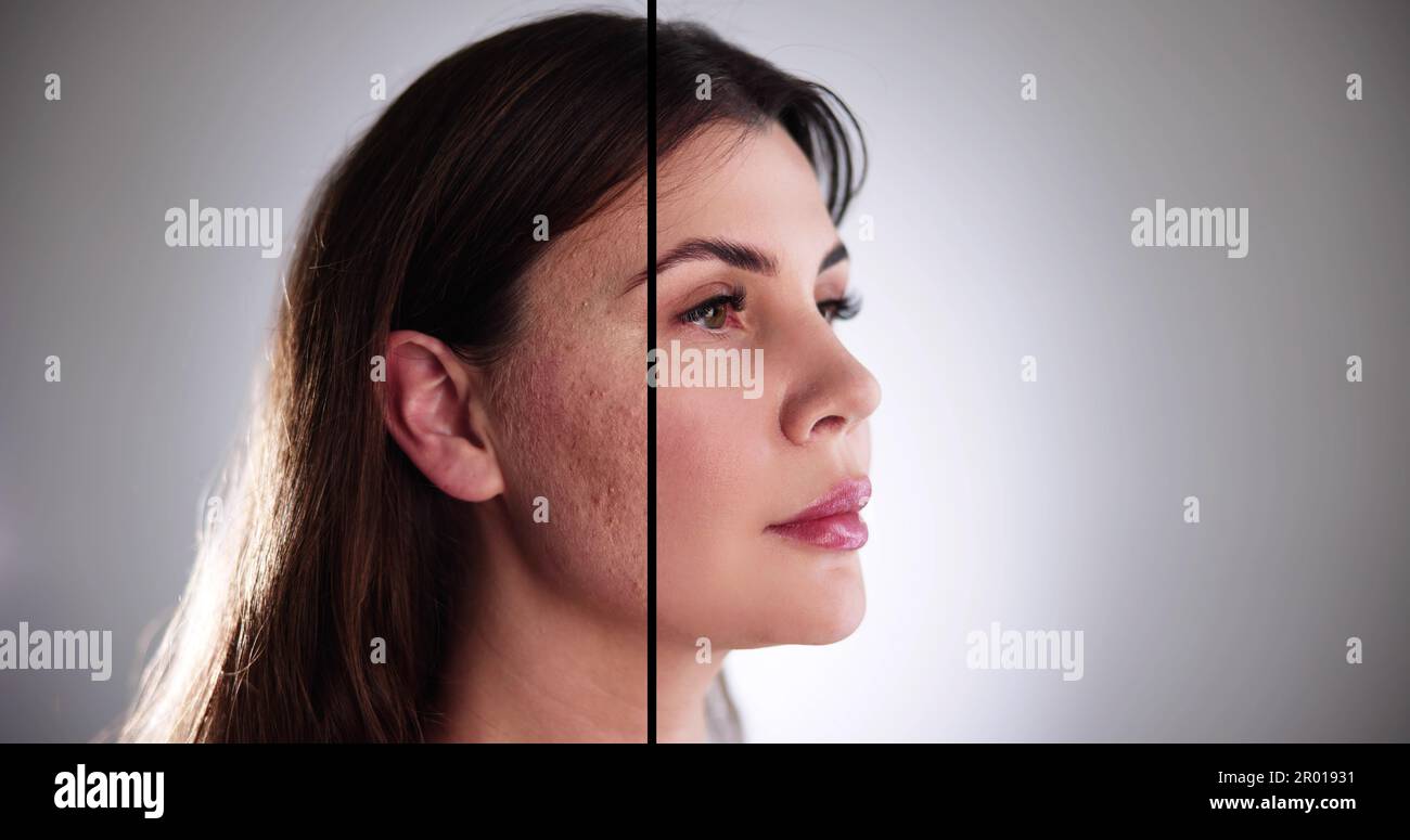 Before After Young Girl Face Wrinkle Treatment Stock Photo - Alamy