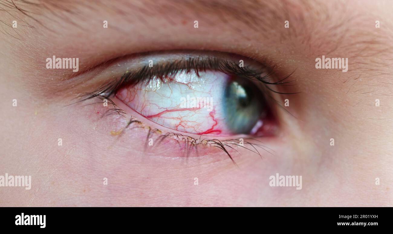 Allergy red eye hi-res stock photography and images - Alamy