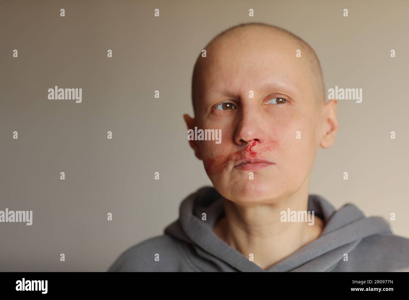 Hairless cancer sick female patient is bleeding from her nose, effects ...