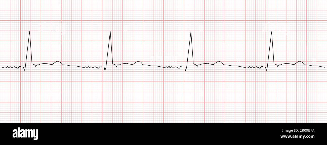 Black heart beat diagram on red graph paper. Electrocardiogram chart ...