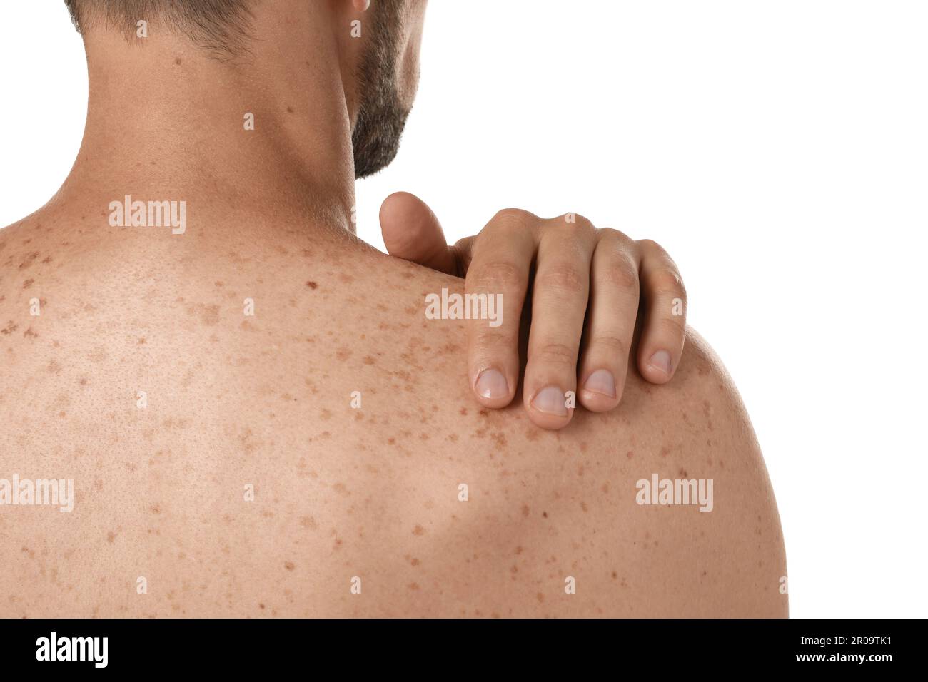Closeup of man`s body with birthmarks on white background, back view ...