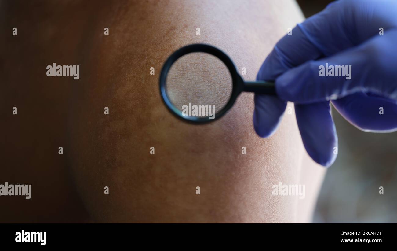 Dermatologist examining mole magnifying glass hi-res stock photography ...