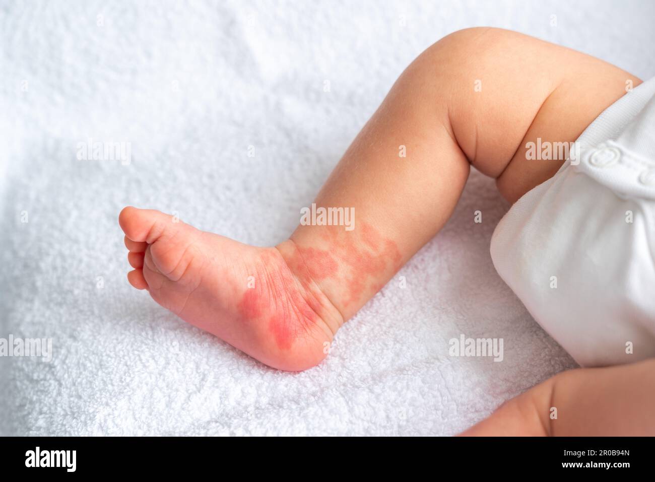 Hemangioma red birthmark on the leg of newborn baby Stock Photo - Alamy