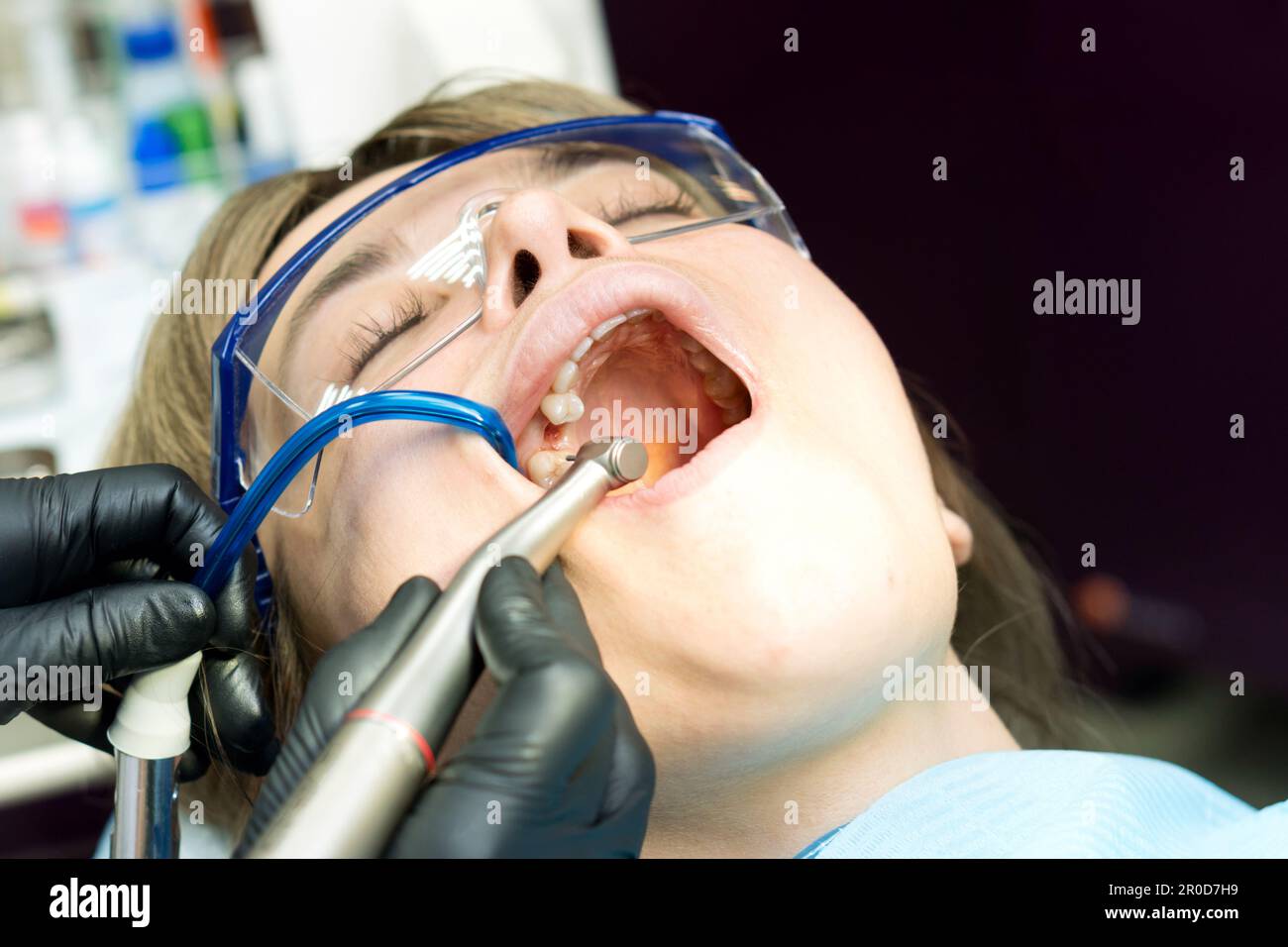 Treatment of caries chewing lateral tooth of the upper jaw. Sanitation ...