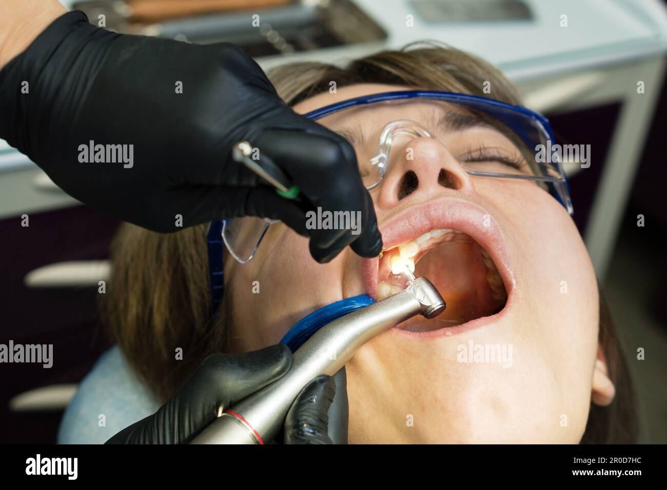 Treatment of caries chewing lateral tooth of the upper jaw. Sanitation ...