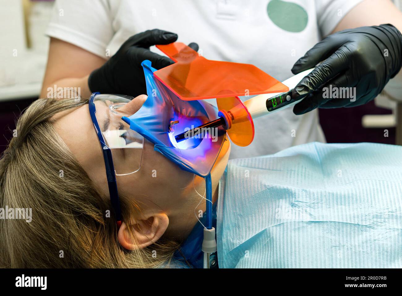 Restoration chewing surface with photopolymer filling material. Dentist ...