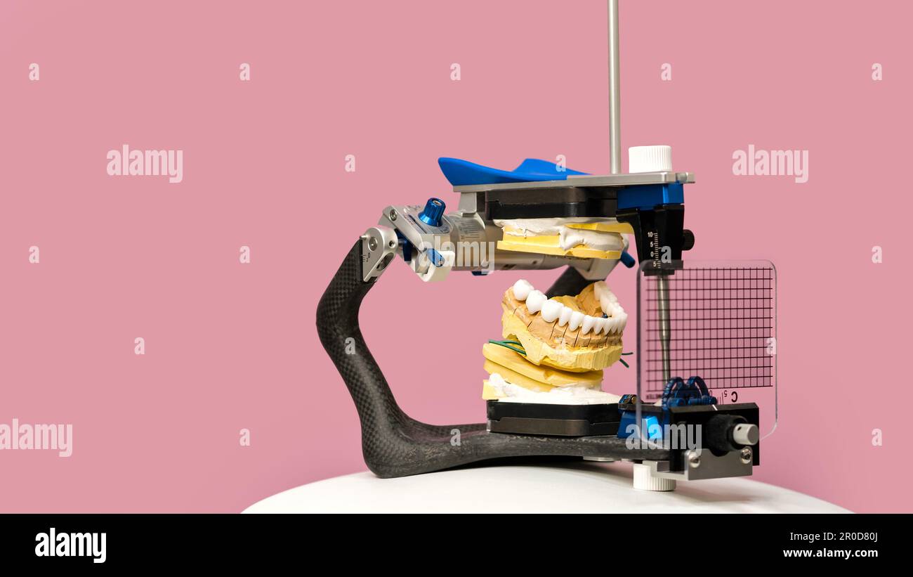 Lower jaw prosthesis on plaster model with veneers and crowns in an ...