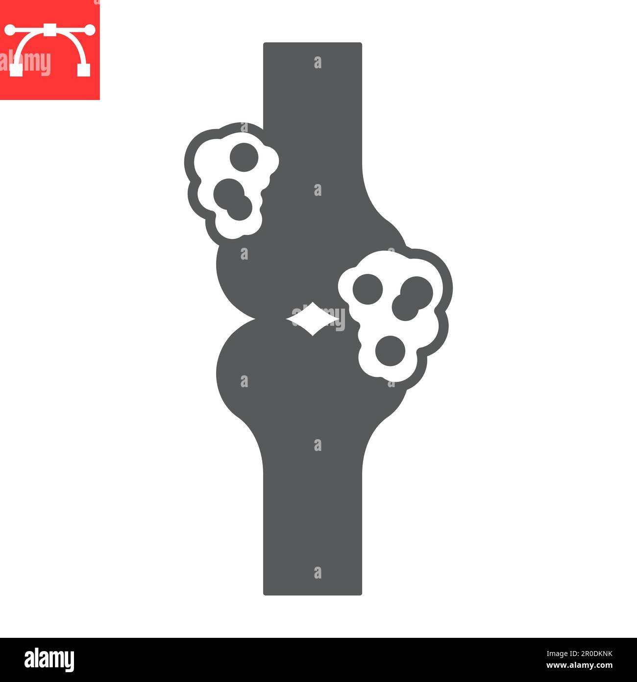 Sarcoma Bone Flat Bone