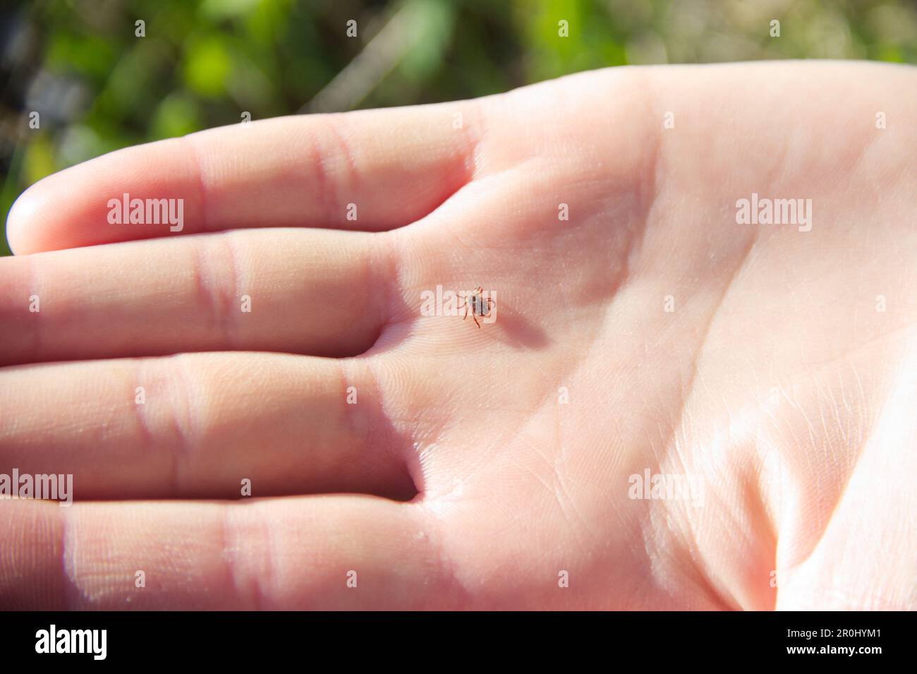Tick crawls on human palm. Ixodes ricinus spreading tick-borne ... Tick crawls on human palm. Ixodes ricinus spreading tick-borne ...