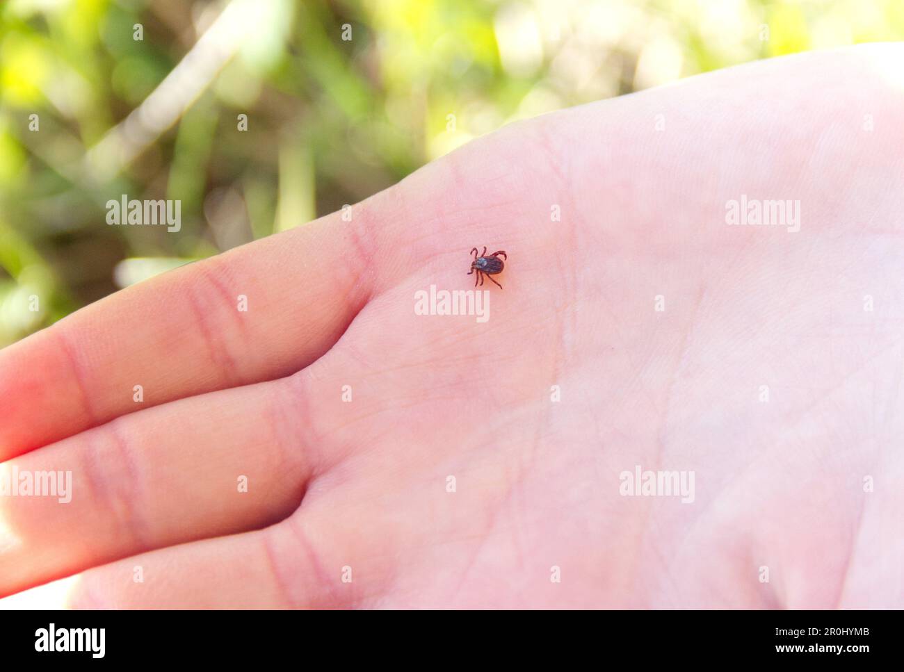 Tick crawls on human palm. Ixodes ricinus spreading tick-borne ... Tick crawls on human palm. Ixodes ricinus spreading tick-borne ...