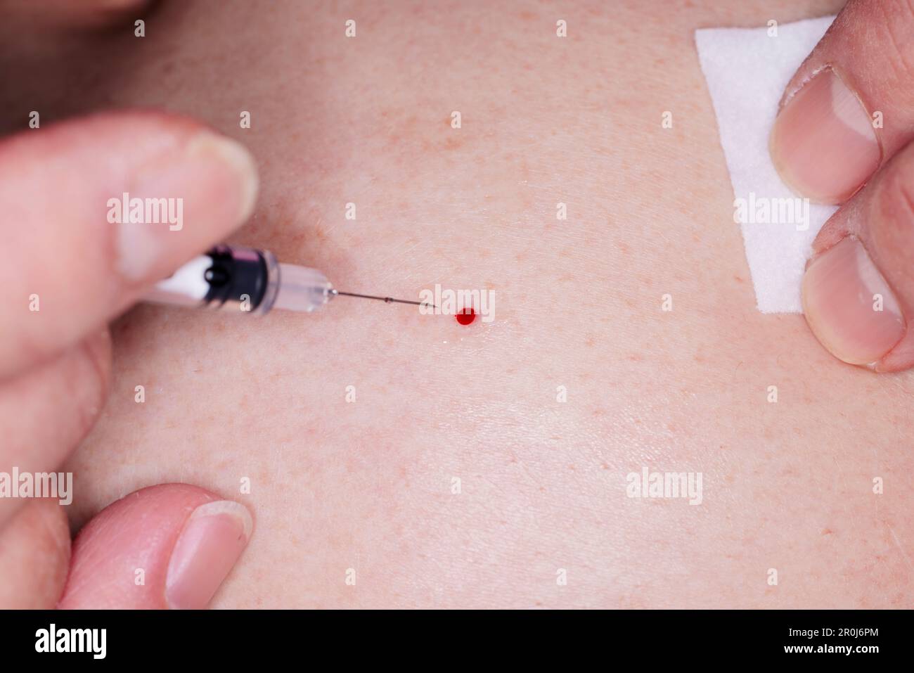 Close up of needle withdrawn from injection site leaving a drop of ...