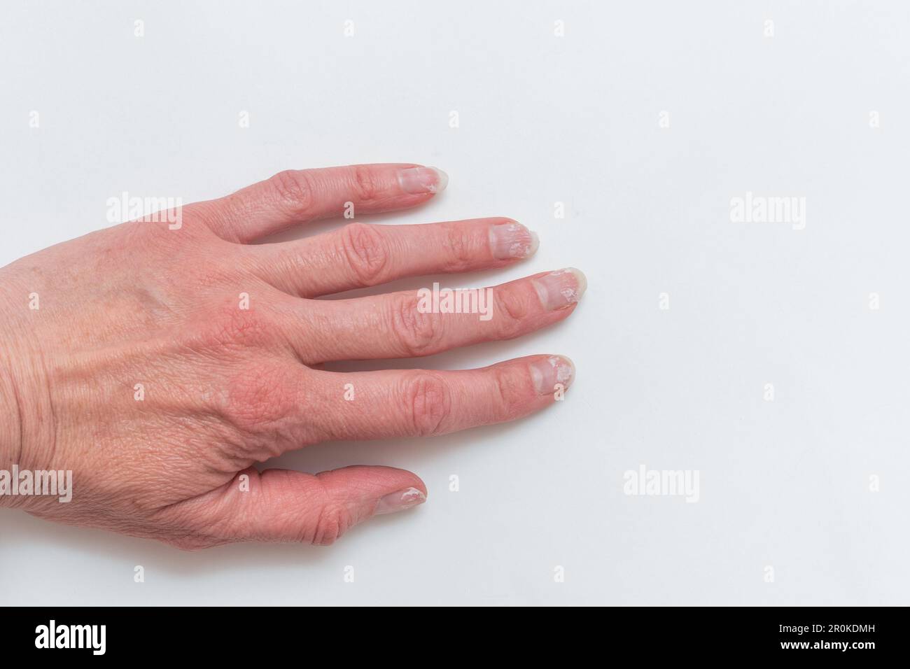 Gout hand hi-res stock photography and images - Alamy