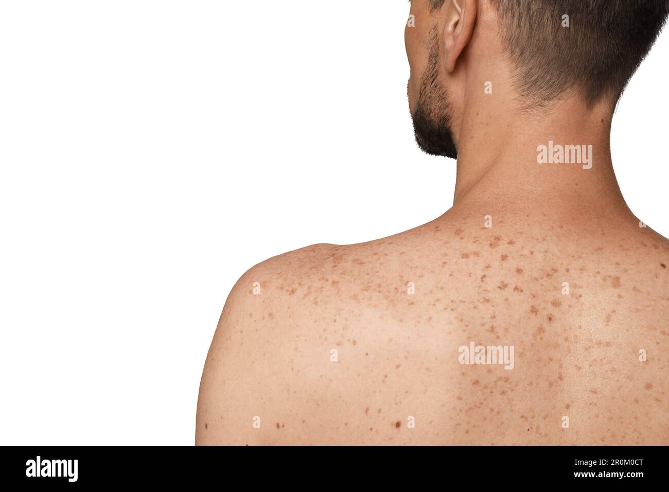 Closeup of man`s body with birthmarks on light grey background, back ...