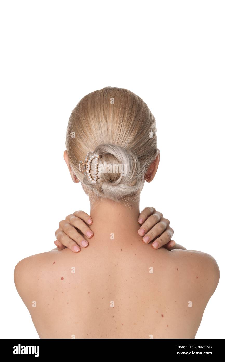 Woman with birthmarks on white background, back view Stock Photo - Alamy