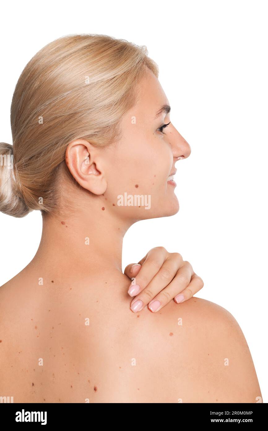 Beautiful young woman with birthmarks on white background Stock Photo ...