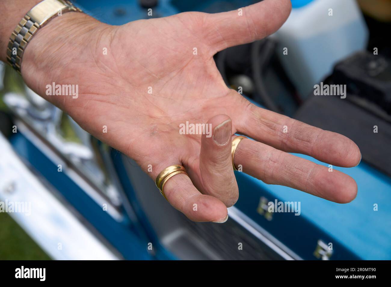 Dupuytren contracture affecting the left hand Stock Photo - Alamy