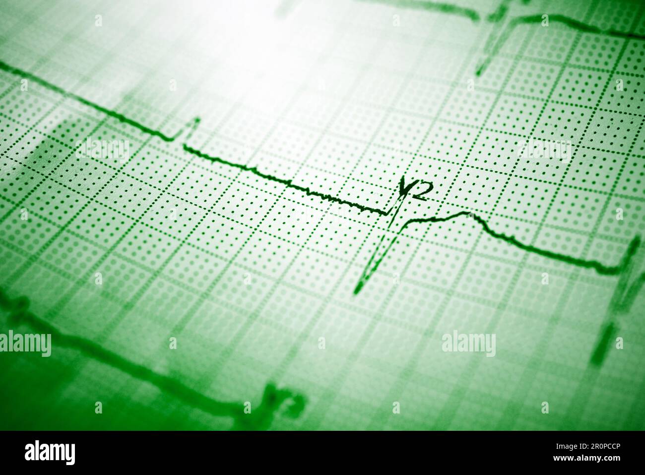 Electrocardiogram showing the pulse of the human heart Stock Photo - Alamy