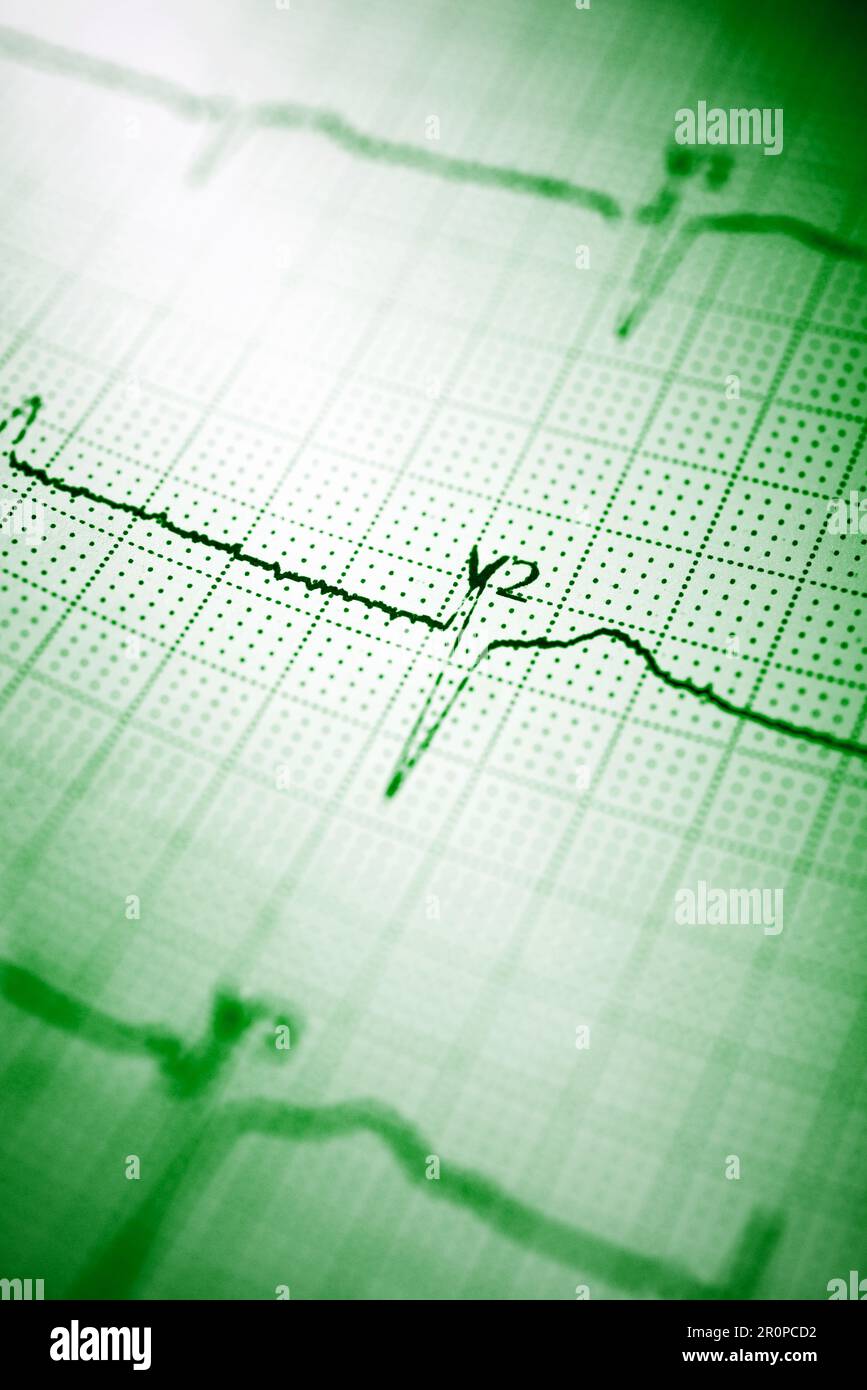 Electrocardiogram showing the pulse of the human heart Stock Photo - Alamy
