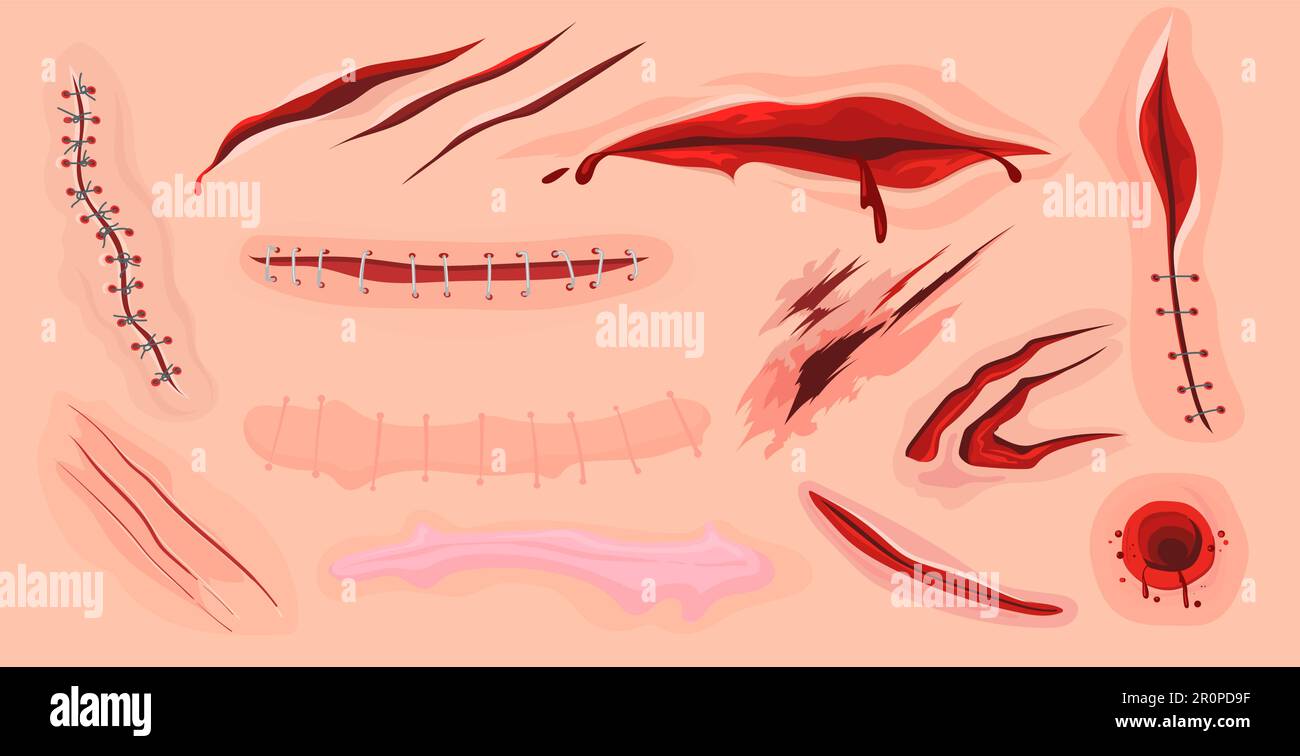 Human skin scars, cuts and bloody wounds flat set for web design Stock ...