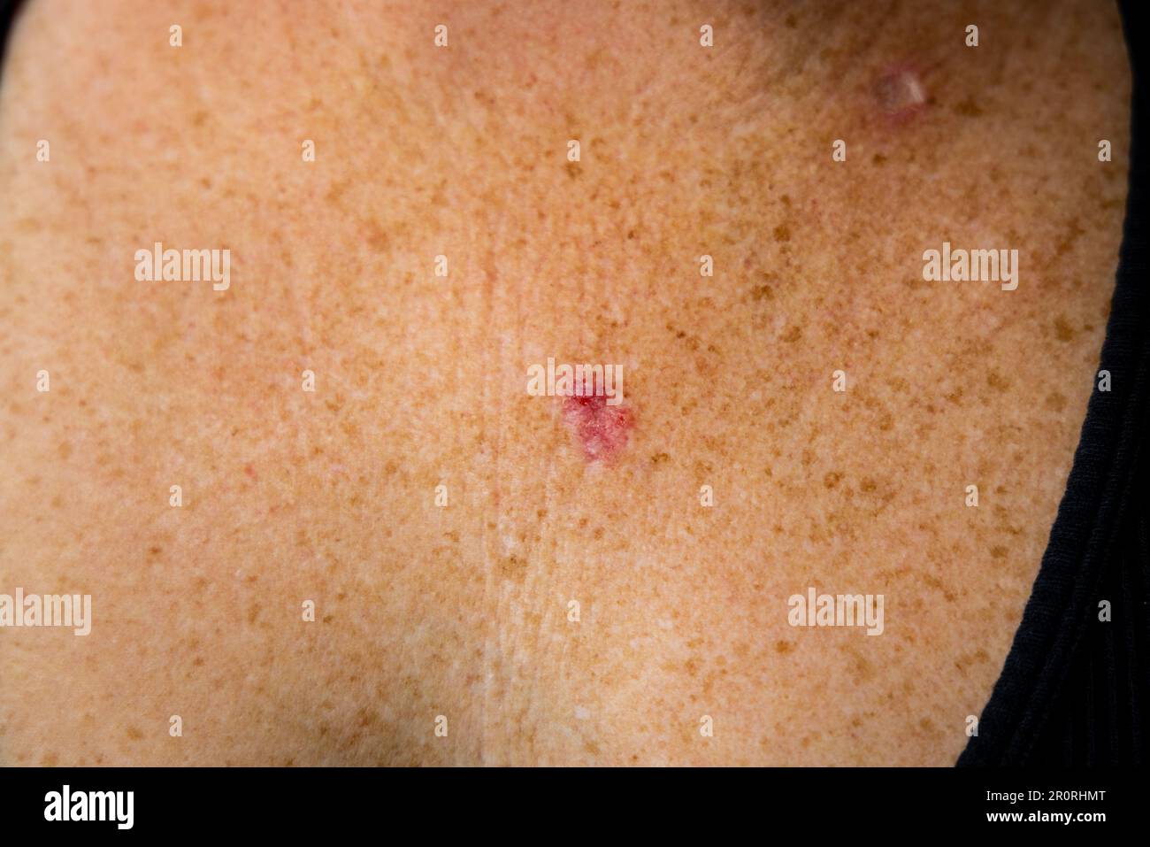 Basal Cell Carcinoma Young at Katie Kendall blog